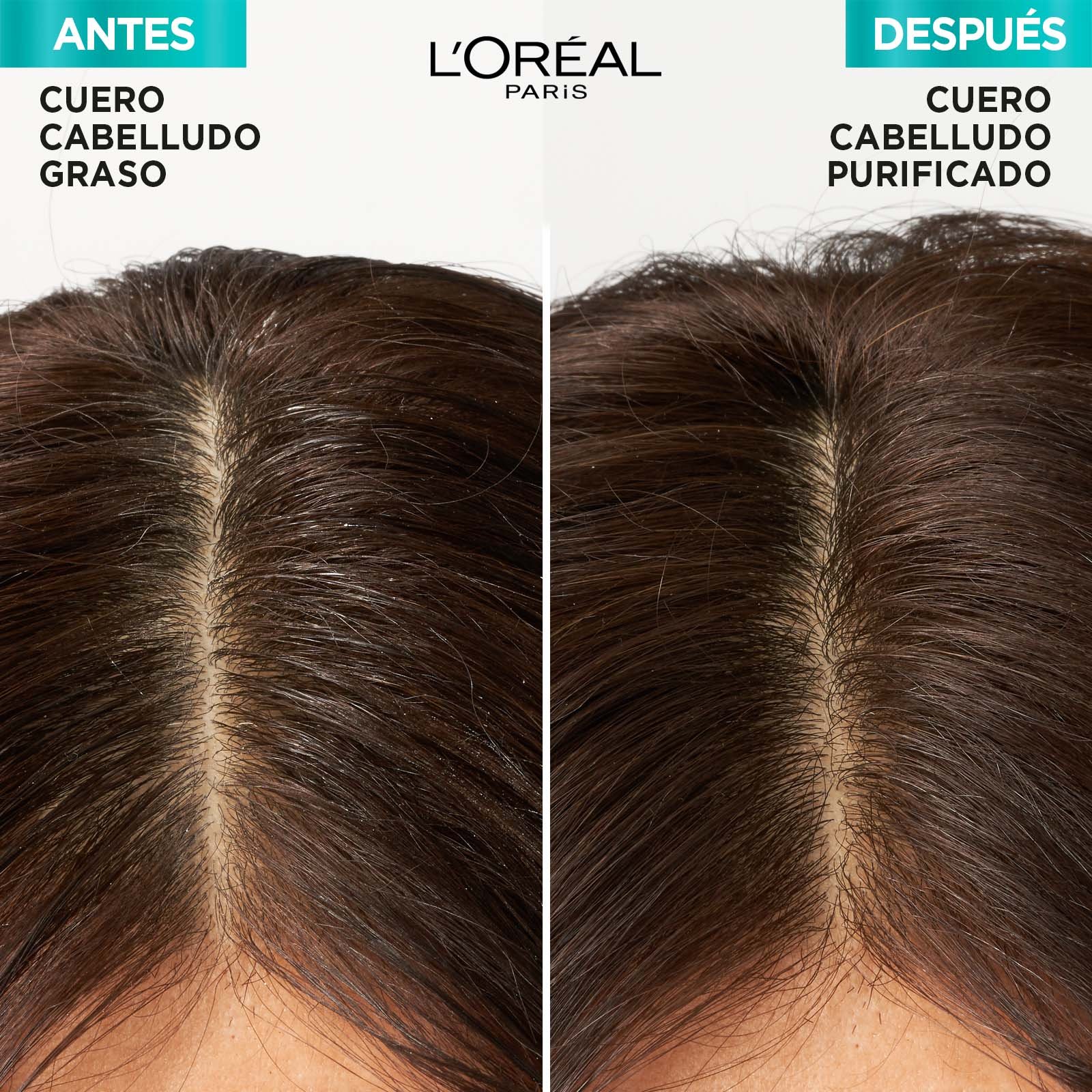 Consejos para cuero cabelludo graso | L'Oreal Paris